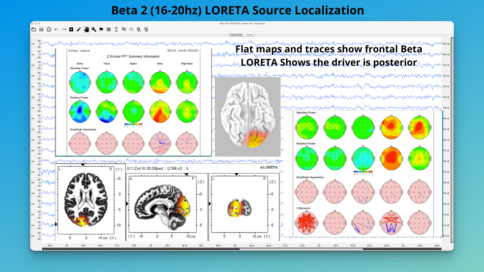 How to use LORETA EEG Source Localization to Understand QEEG | Peak ...